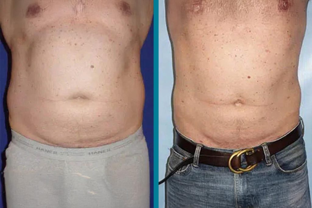 Stomach Liposuction NYC - Abdomen Liposuction Specialists