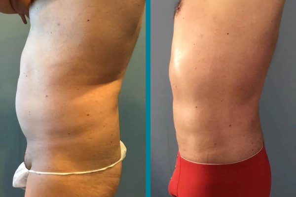 Liposuction New York City | J-Plasma & SmartLipo Specialist in NYC