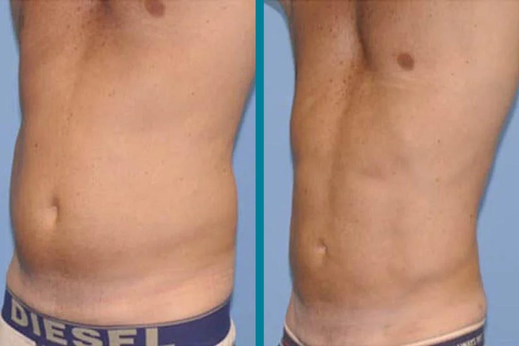Lipo 360 NYC - Remove Stubborn Fat Permanently | Alinea Lipo