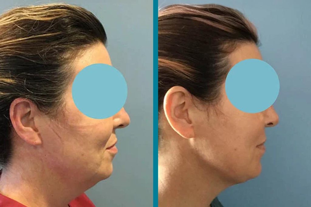 Double Chin Liposuction | Before & After | Alinea Lipo NYC