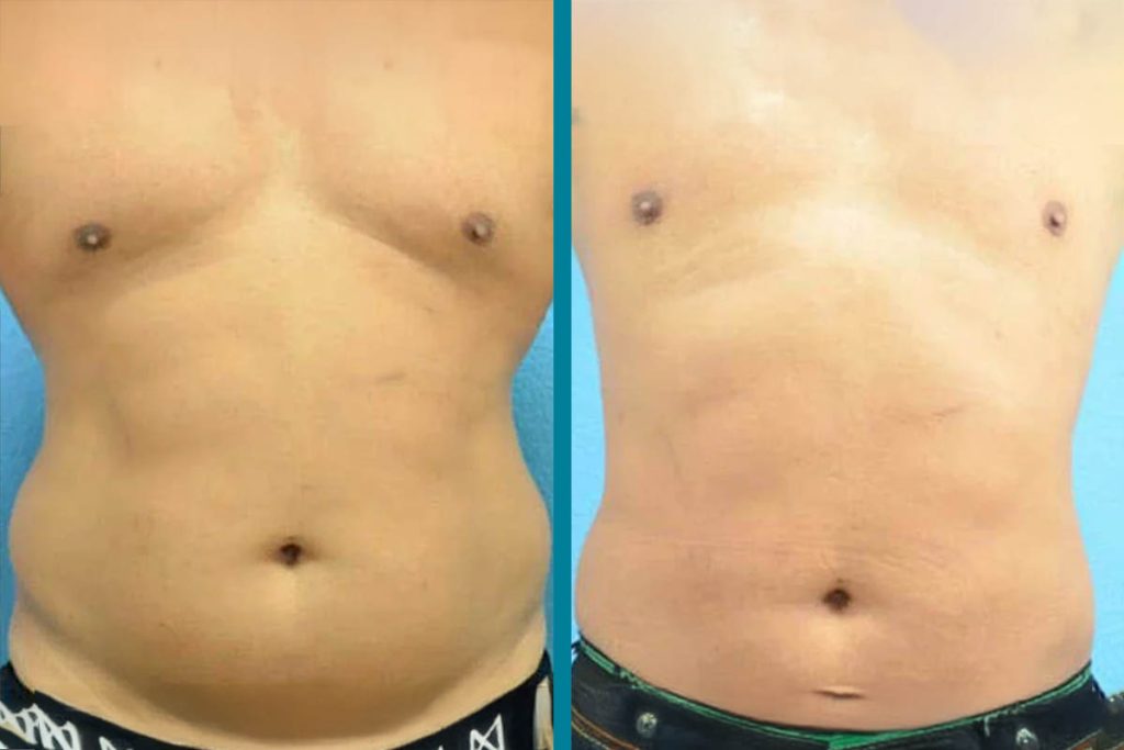 Lipo 360 NYC - Remove Stubborn Fat Permanently | Alinea Lipo