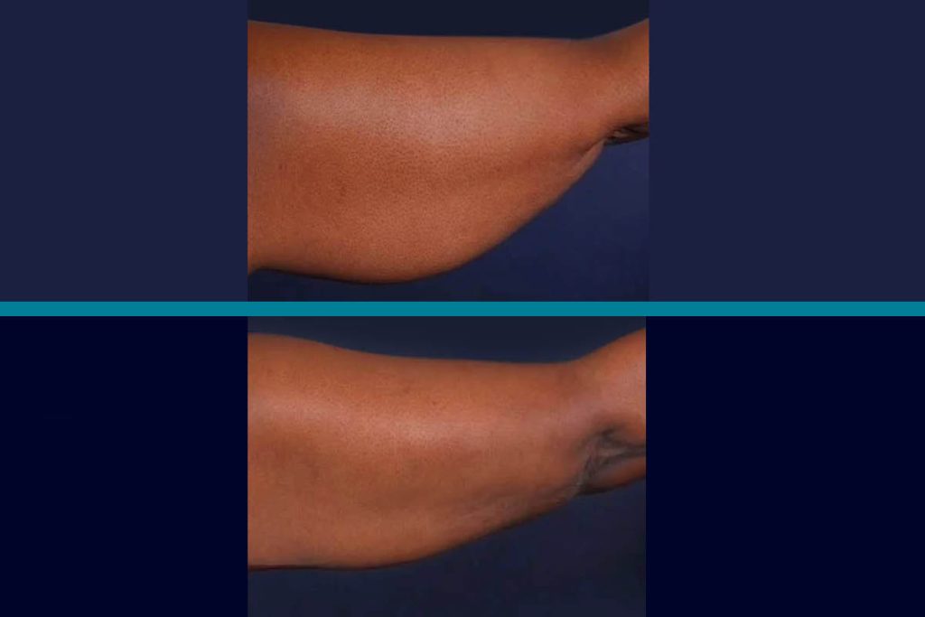 Laser Liposuction Fat Removal Clinic in NYC | Alinea Lipo