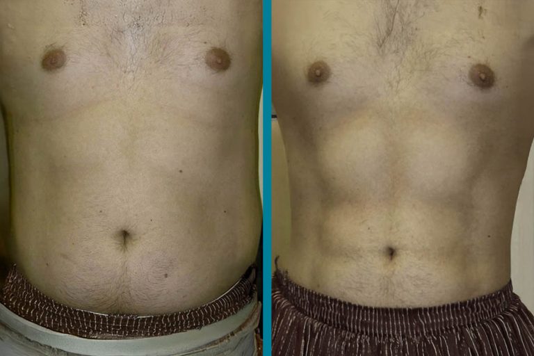 Stomach Liposuction NYC - Abdomen Liposuction Specialists