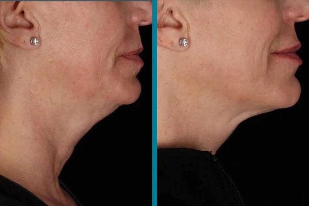 Laser Liposuction Fat Removal Clinic in NYC | Alinea Lipo