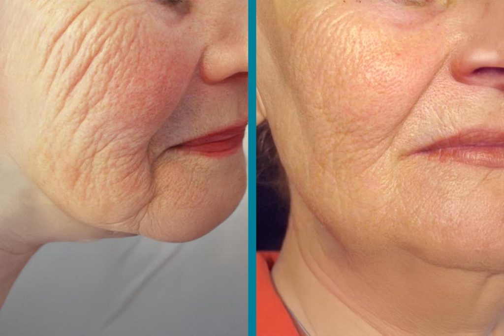 Double Chin Liposuction | Before & After | Alinea Lipo NYC