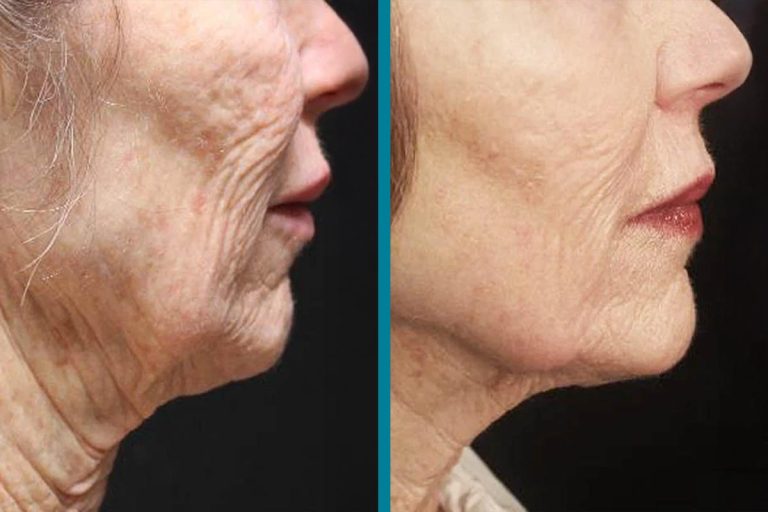 Neck Skin Tightening New York City | Effective Turkey Neck Surgery