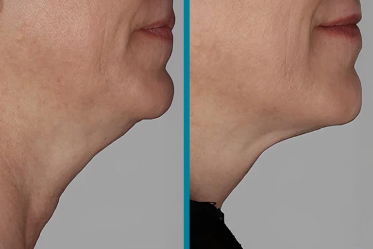Neck Skin Tightening New York City | Effective Turkey Neck Surgery