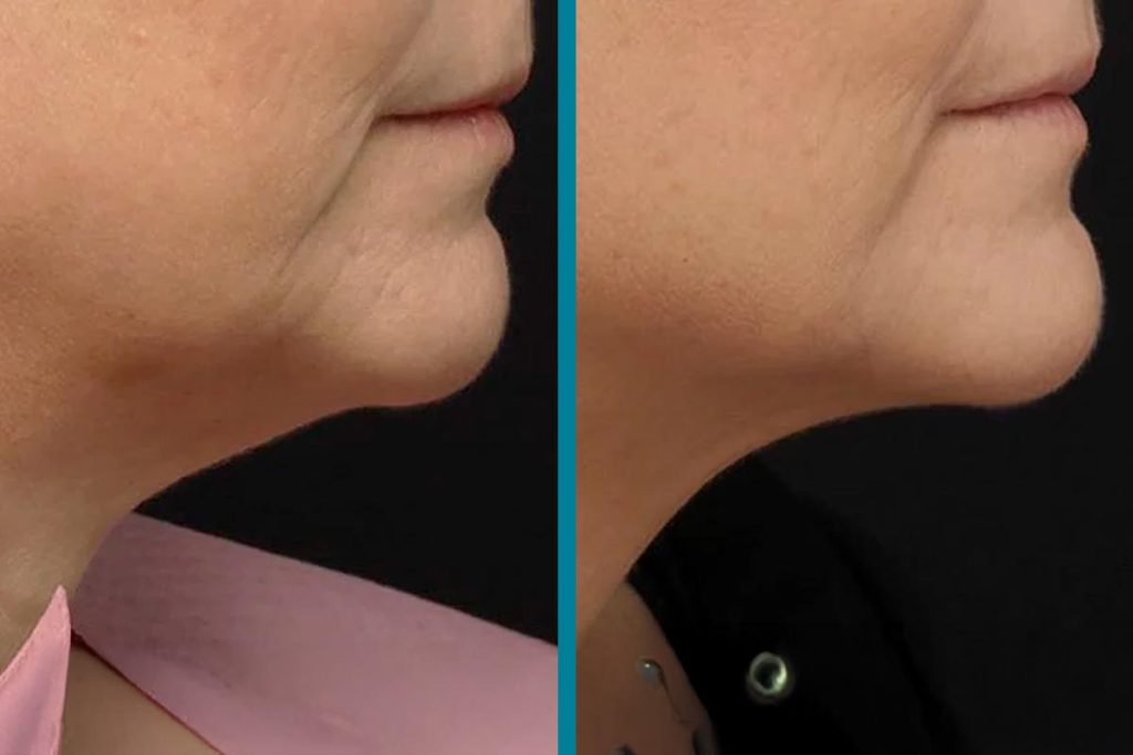 Neck Skin Tightening New York City | Effective Turkey Neck Surgery