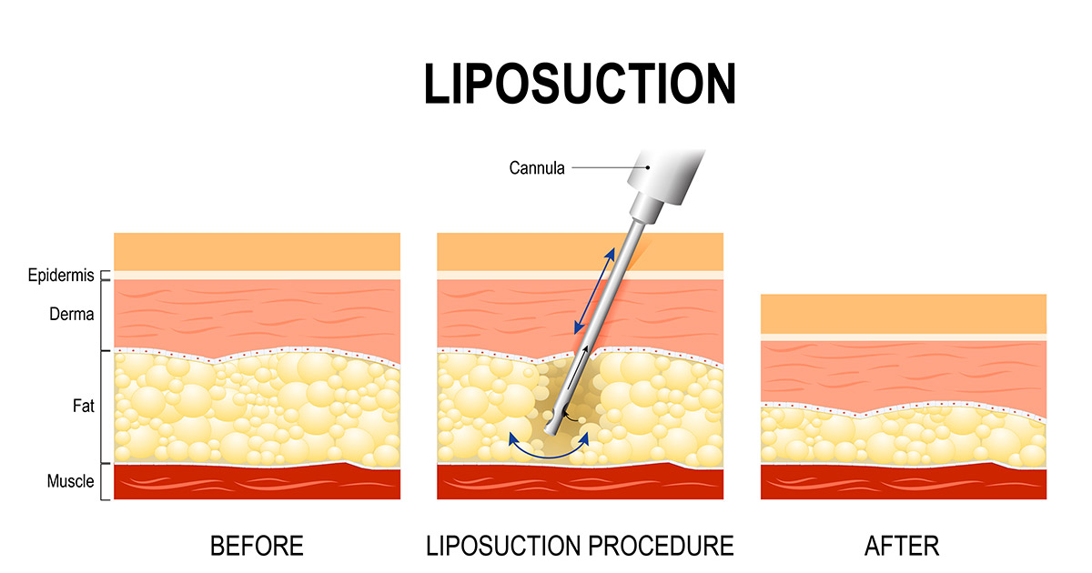 How Much Fat Can Be Removed with Lipo 360 | Alinea Lipo NYC